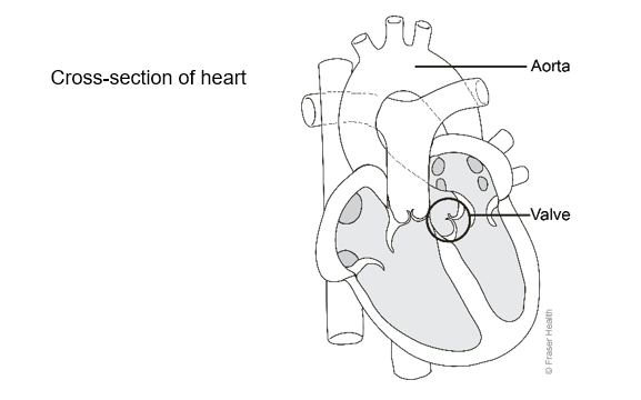 Transcatheter aortic valve implantation (TAVI) - Fraser Health Authority