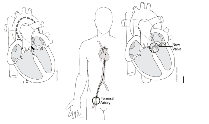 Transcatheter aortic valve implantation (TAVI) - Fraser Health Authority